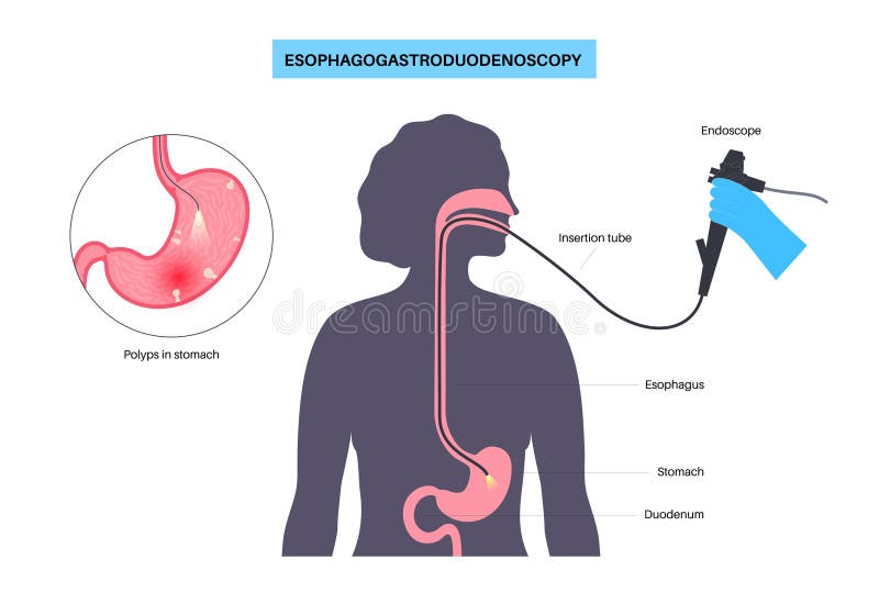 Egd System Stock Illustrations – 123 Egd System Stock Illustrations ...