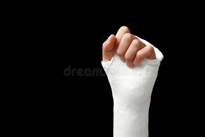 Gebrochener Arm - 06 stockbild. Bild von syndrom, menschlich - 22709631