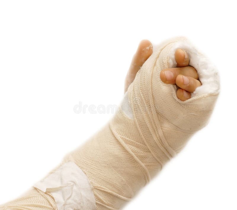 Gebrochener Arm stockbild. Bild von medizinisch, verband - 22183201