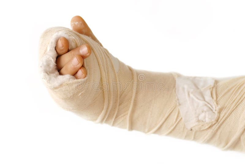 Gebrochener Arm stockbild. Bild von medizinisch, verband - 22183201