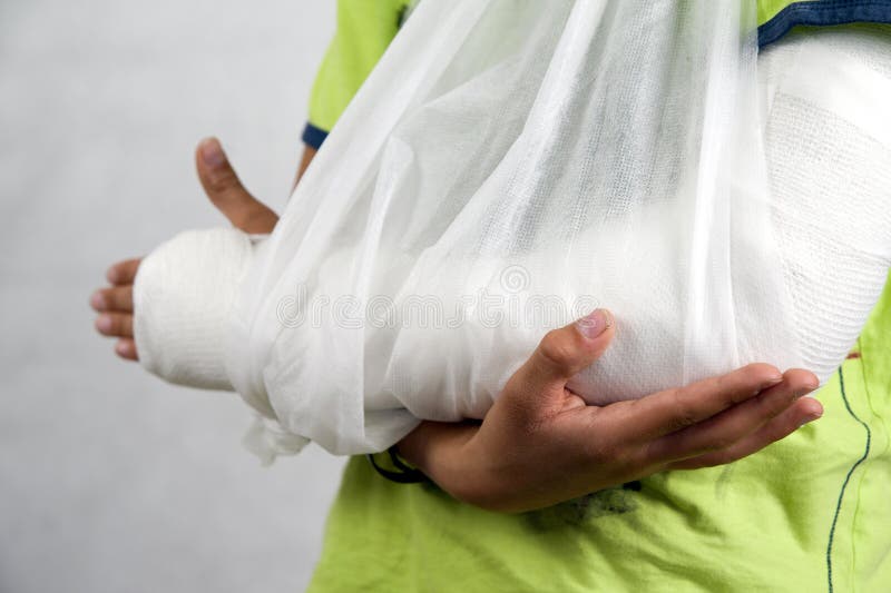 Gebrochener Arm in Der Form Stockbild - Bild von knochen, gesundheit ...
