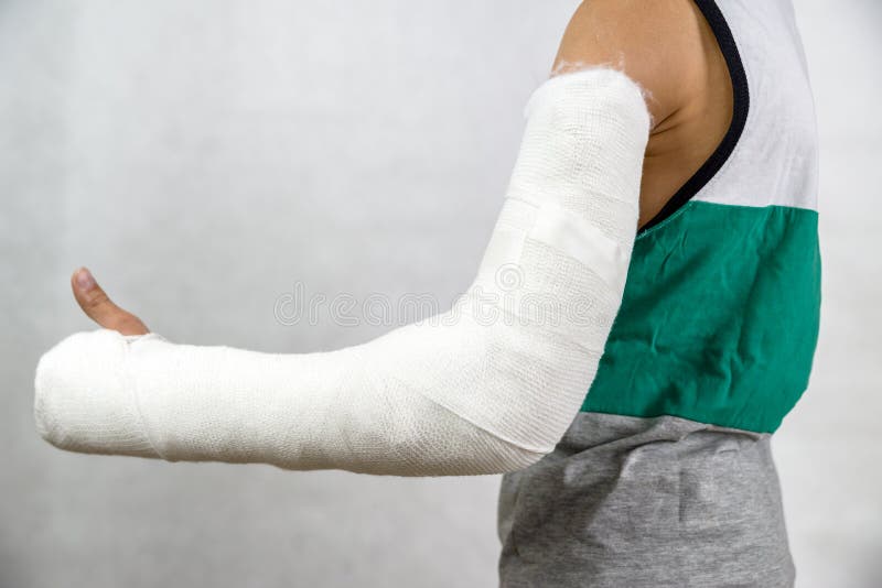 Gebrochener Arm in Der Form Stockfoto - Bild von hand, gesundheit ...