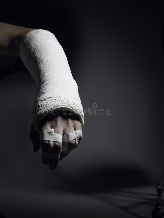 Gebrochener Arm und Finger stockfoto. Bild von industriell - 23385898