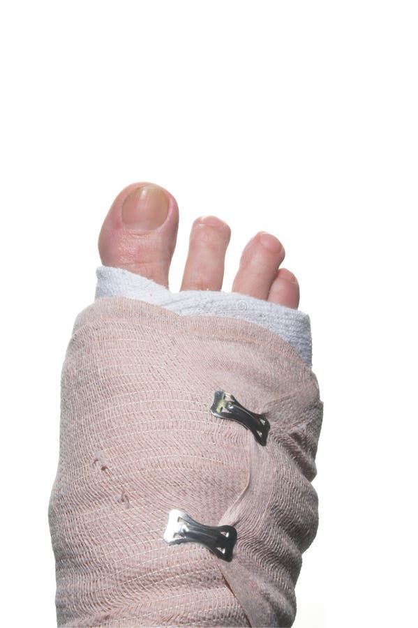 Gebrochener Fuß stockfoto. Bild von behandlung, knochen - 3822410