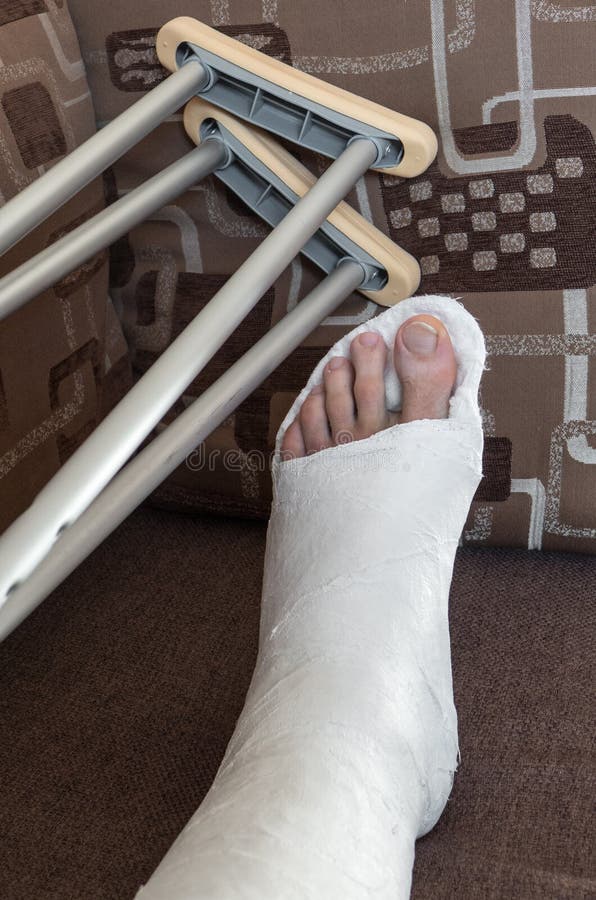 Gebrochenes Bein im Gips stockbild. Bild von bruchstück - 82046271