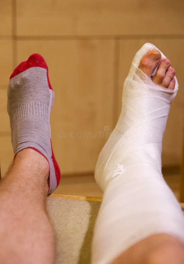 Gebrochenes Bein im Gips stockbild. Bild von mann, stuhl - 82046271