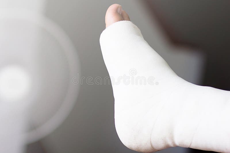 Gebroken Been stock foto. Image of enkels, herstellen - 125883232