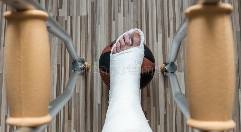 Gebroken been in gips stock afbeelding. Image of splinter - 82046271