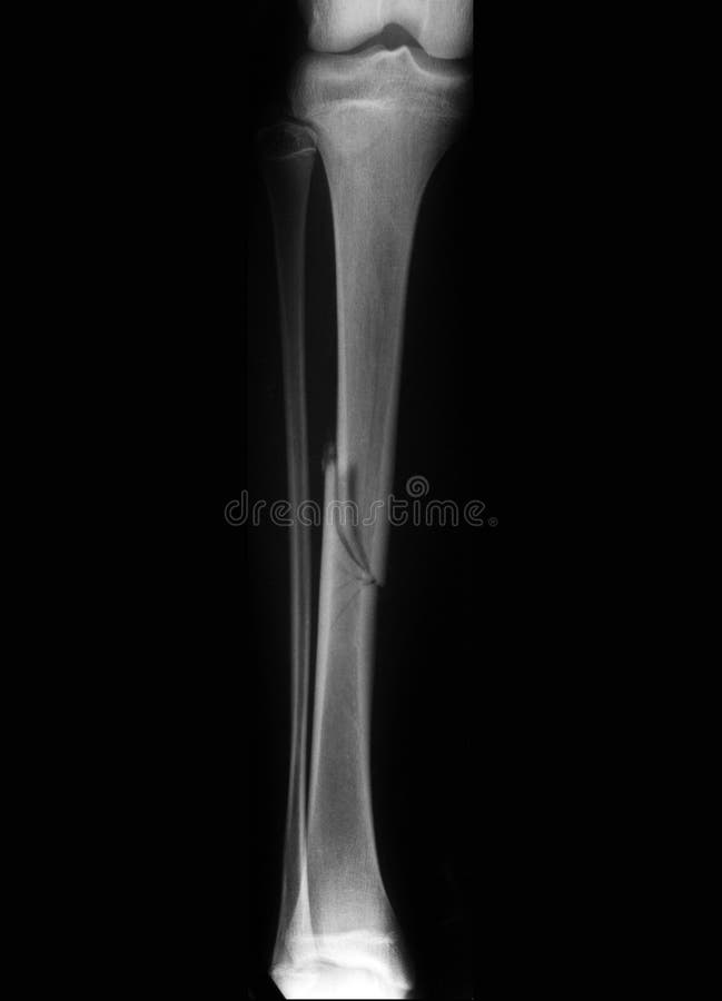 Gebroken Dijbeen Gebroken Been Stickers | Unieke Designs | Spreadshirt