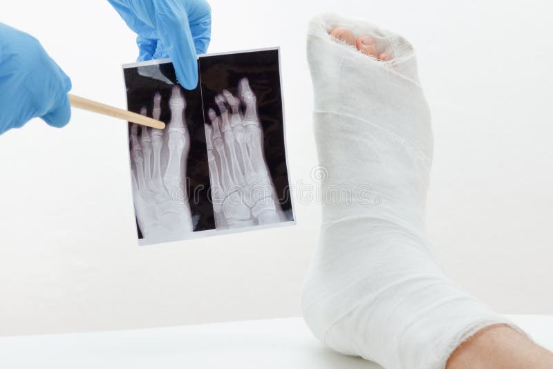 De Mens Met Gebroken Been Van Het Ongeval in Gipsverbandsplinter is in ...