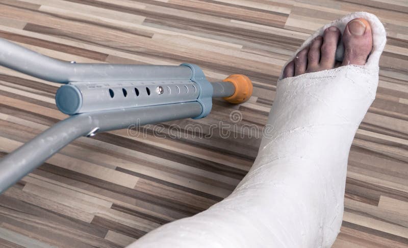 Gebroken been in gips stock afbeelding. Image of splinter - 82046271
