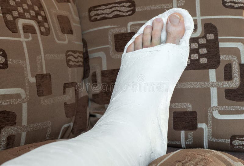 Gebroken enkel in gips stock foto. Image of been, enkel - 65568598