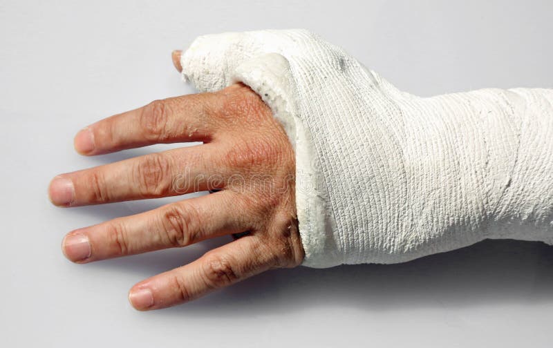 Gebroken Hand Van De Man Met Het Orthopedische Gipsverband En a Stock ...