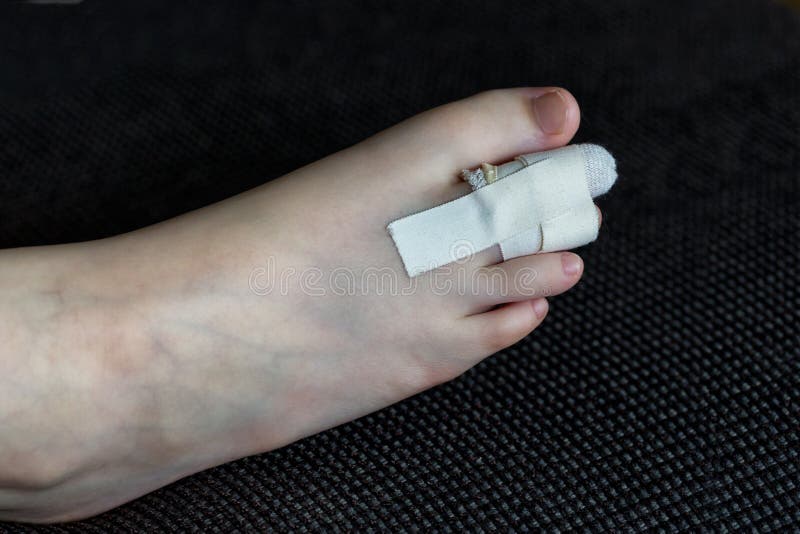 Gebroken teen en verband stock foto. Image of vulling - 95636076