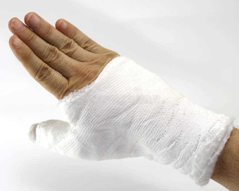Hand Met Gebroken Beenderen in De Orthopedische Het ...