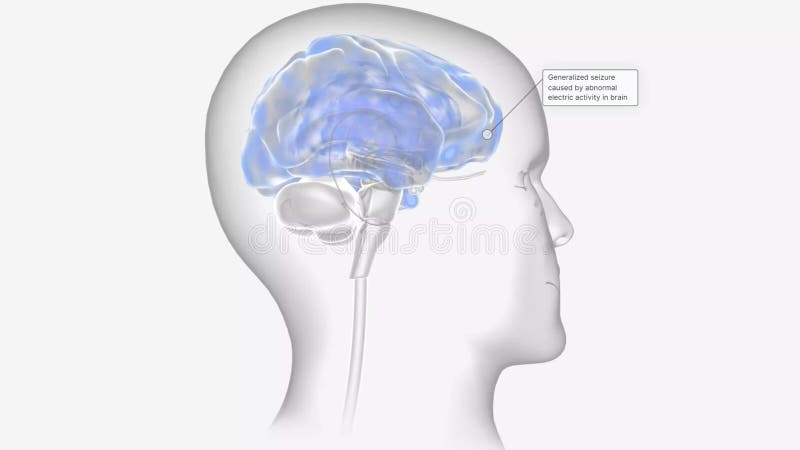 Generalized Seizure Caused by Abnormal Electric Activity in Brain Stock ...