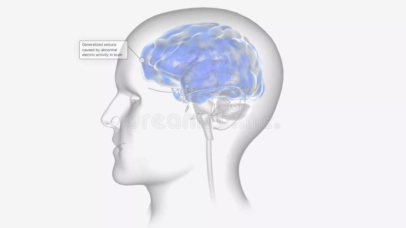 Generalized Seizure Caused by Abnormal Electric Activity in Brain Stock ...