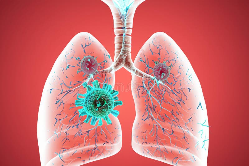 Lungs. Pertussis. Whooping Cough. Bordetella Pertussis. Lungs with ...