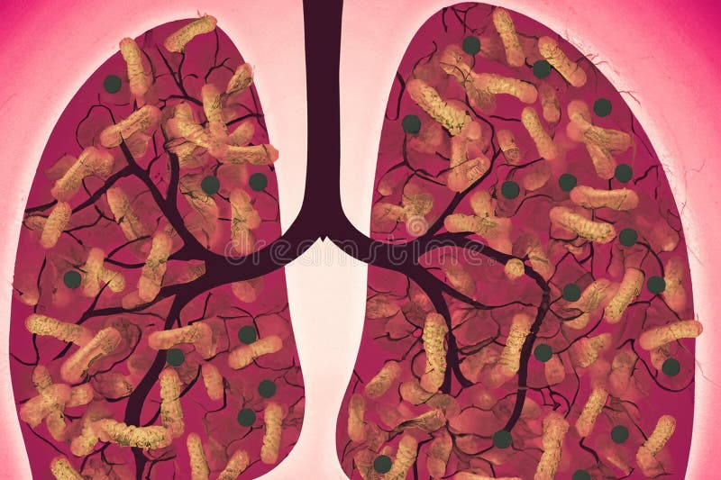 Lungs. Pertussis. Whooping Cough. Bordetella Pertussis. Lungs with ...