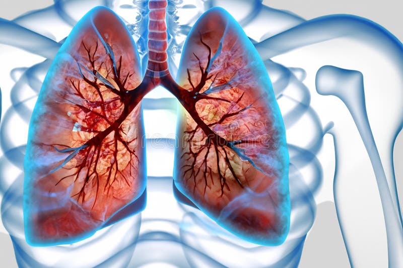 Lungs. Pertussis. Whooping Cough. Bordetella Pertussis. Lungs with ...