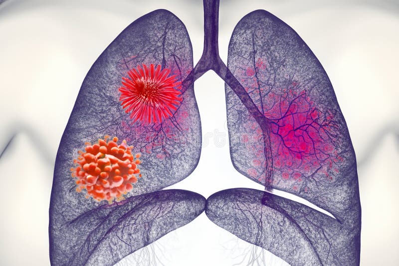 Lungs. Pertussis. Whooping Cough. Bordetella Pertussis. Lungs with ...