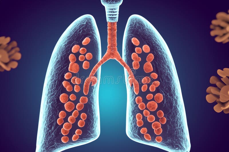 Lungs. Pertussis. Whooping Cough. Bordetella Pertussis. Lungs with ...