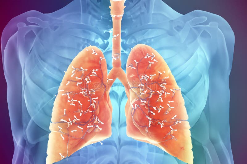 Lungs. Pertussis. Whooping Cough. Bordetella Pertussis. Lungs with ...