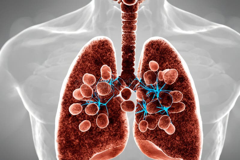 Lungs. Pertussis. Whooping Cough. Bordetella Pertussis. Lungs with ...