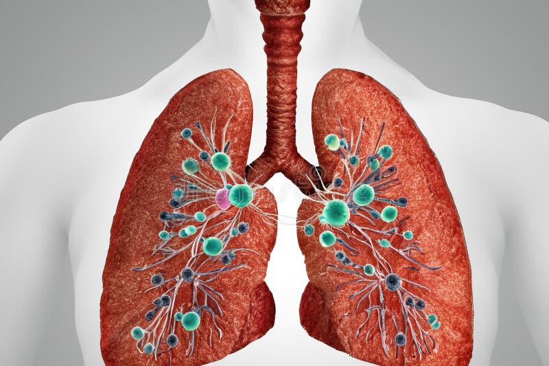 Lungs. Pertussis. Whooping Cough. Bordetella Pertussis. Lungs with ...