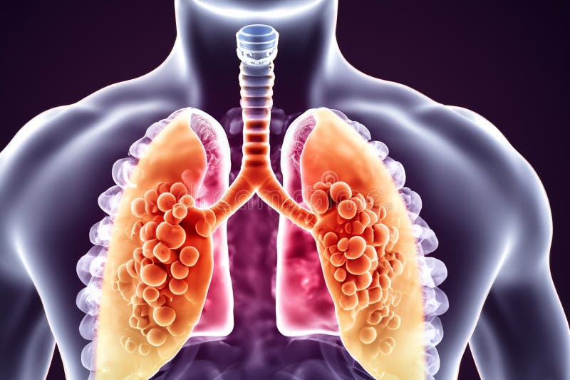 Lungs. Pertussis. Whooping Cough. Bordetella Pertussis. Lungs with ...