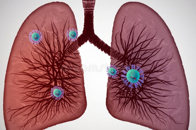 Lungs. Pertussis. Whooping Cough. Bordetella Pertussis. Lungs with ...