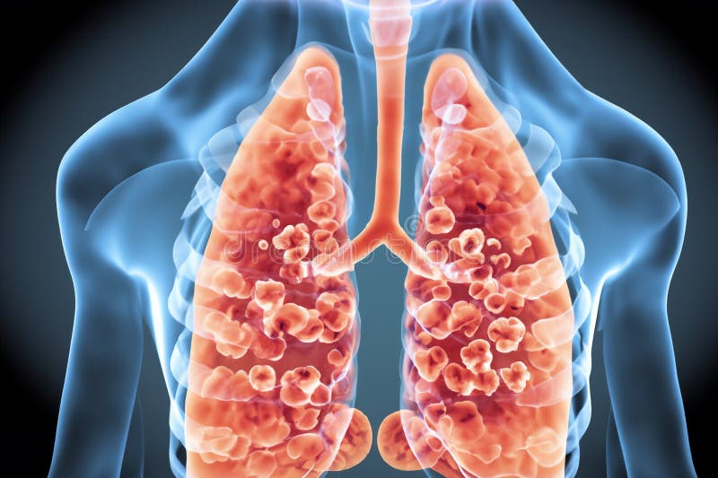 Lungs. Pertussis. Whooping Cough. Bordetella Pertussis. Lungs with ...