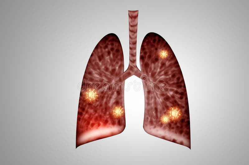 Lungs. Pertussis. Whooping Cough. Bordetella Pertussis. Lungs with ...