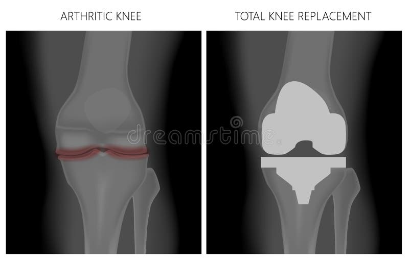 Problem_Dislocation D'articulation Du Genou De La Rotule Illustration ...