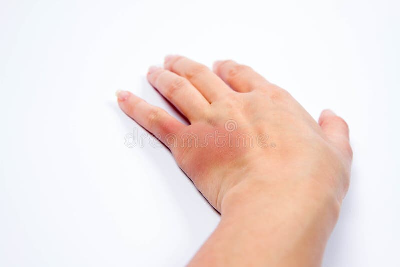 Gequetschte Hand stockbild. Bild von quetschung, locher - 101635219