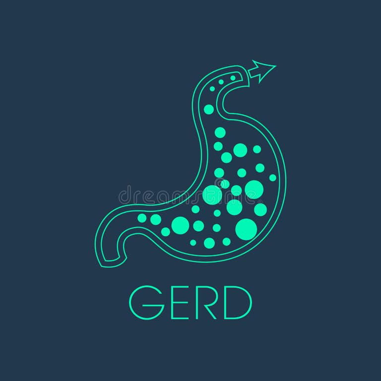 Gerd Anatomy Stock Illustrations – 470 Gerd Anatomy Stock Illustrations ...