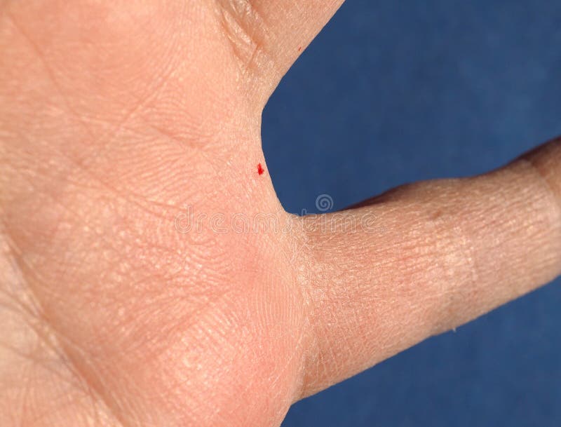 Hand mit Quetschung stockfoto. Bild von bissen, kruste - 4173298