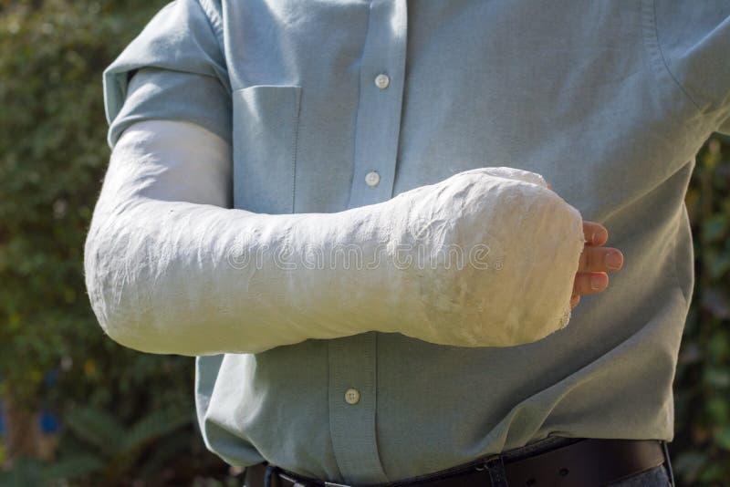 4,686 Braccio Gesso Foto - Foto Stock Gratis e Royalty-Free da Dreamstime