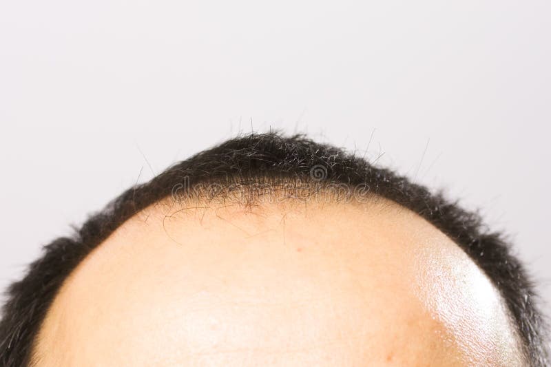 Balding head stock image. Image of improvement, forehead - 5300257
