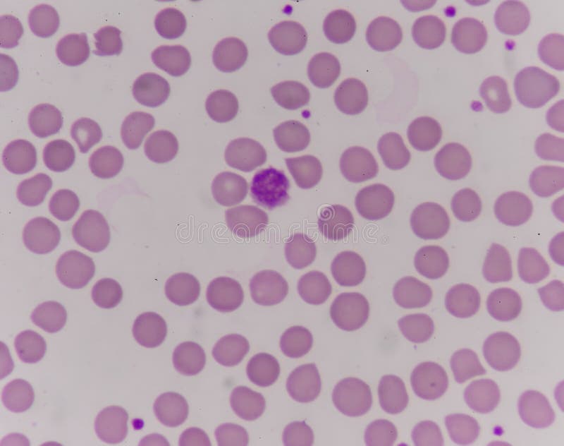 Giant Platlet on Red Blood Cells Stock Image - Image of sample ...