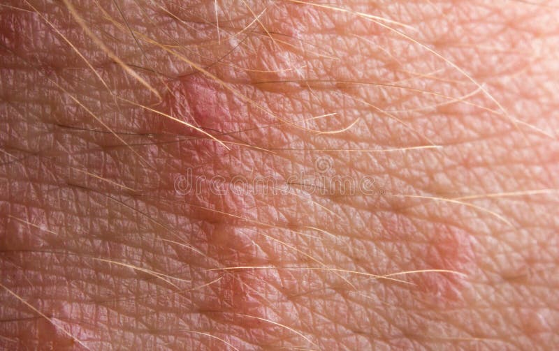 Giftefeu Und -hautausschlag Stockbild - Bild von hautentzündung, eiche ...