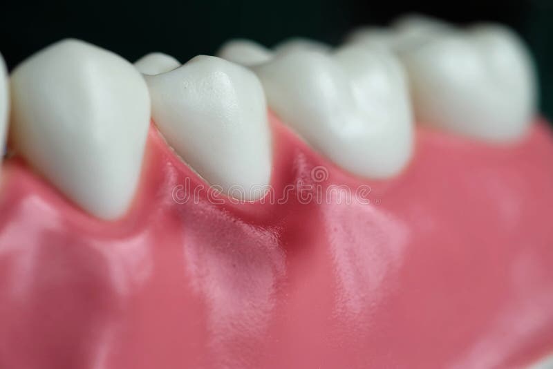 Teeth and gingivitis stock image. Image of dental, dentist - 14333893