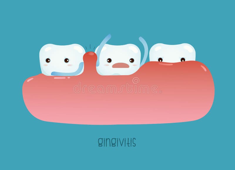 Gingivitis of Dental Vector Stock Vector - Illustration of treatment ...