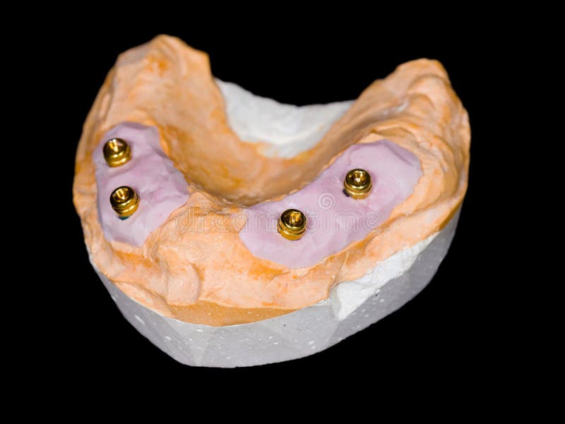 Gipsmodell Eines Menschlichen Kieferbereich Mit Den Zähnen, in Einem ...