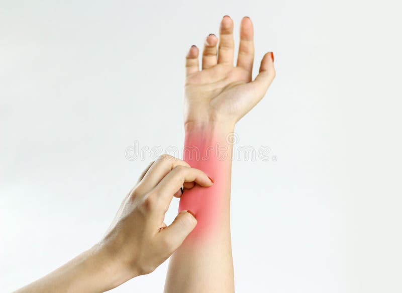 Scratch In Hands. Itchy Fingers, Allergy Hands Stock Image - Image of ...