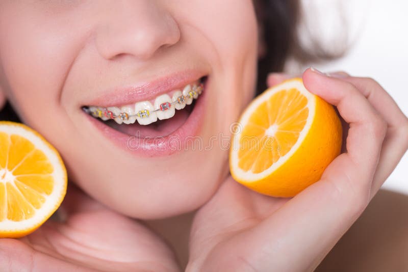 Girl with Multi-colored Braces Tastes a Lemon Stock Image - Image of ...