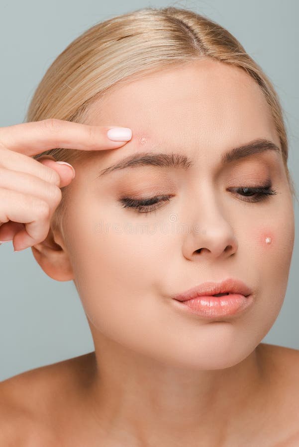 Girl Pointing with Finger at Face with Acne on Grey Stock Photo - Image ...