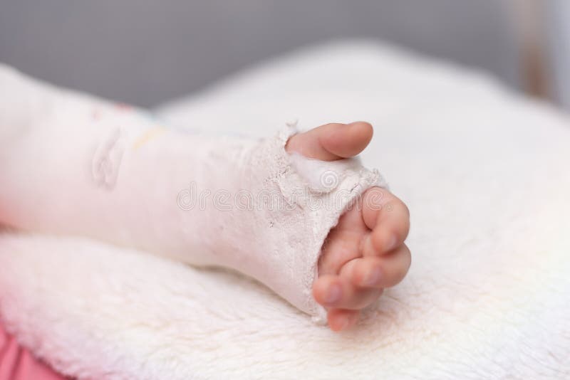 Girl`s Broken Left Arm Has Drawn a Cute Image on Her Arm on the Plaster ...
