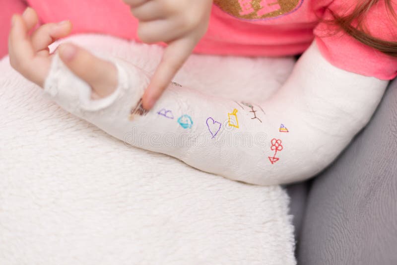 Girl`s Broken Left Arm Has Drawn a Cute Image on Her Arm on the Plaster ...