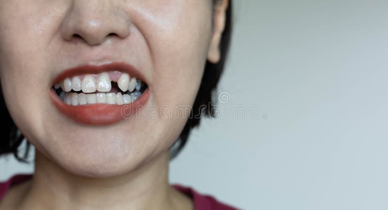 Girl`s Teeth, Missing Teeth, Bad Dental Health Stock Image - Image of ...
